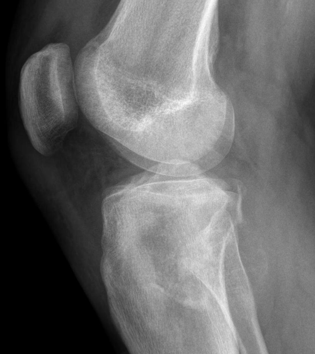 Conventional Osteosarcoma The Bone School